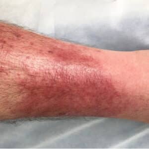 Erysipelas - Grand Strand Dermatology, LLC