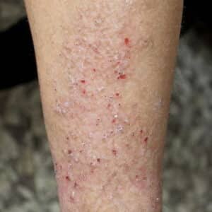 Lichen Simplex Chronicus - Grand Strand Dermatology, LLC