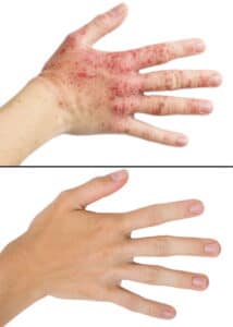 Rashes - Grand Strand Dermatology, LLC