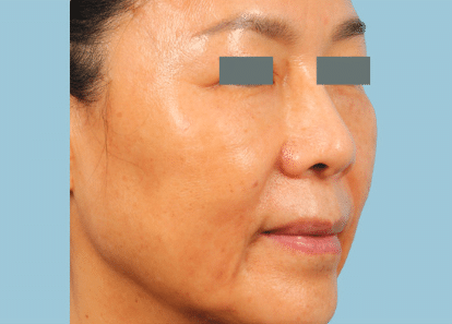 Matrix Pro RF Applicator - Grand Strand Dermatology, LLC