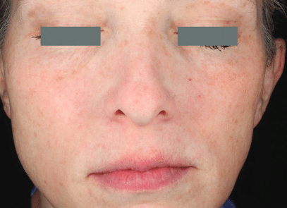 Matrix Pro RF Applicator - Grand Strand Dermatology, LLC