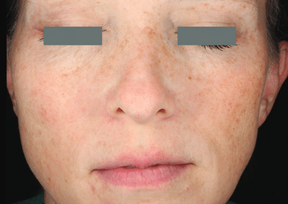 Matrix Pro RF Applicator - Grand Strand Dermatology, LLC