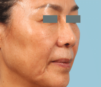 Matrix Pro RF Applicator - Grand Strand Dermatology, LLC